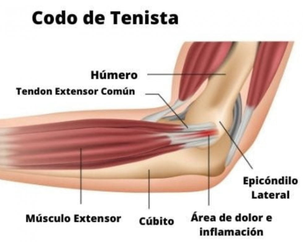 Epicondilitis, cómo tratarla desde la fisioterapia