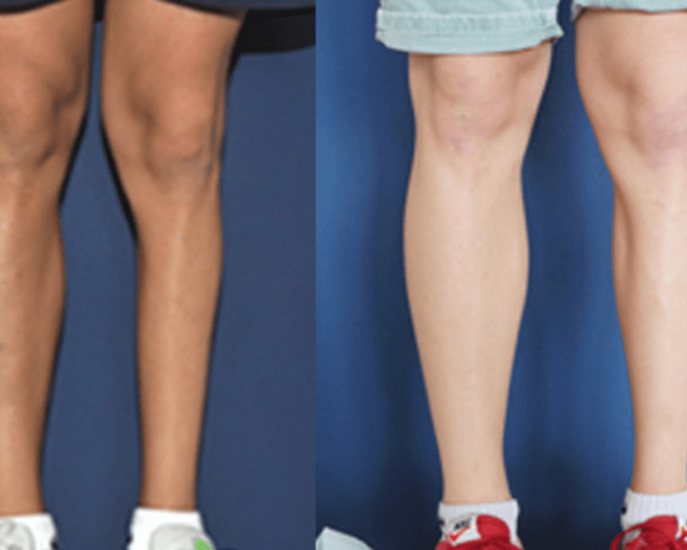 Fisioterapia para la atrofia muscular: cómo recuperar fuerza y ...